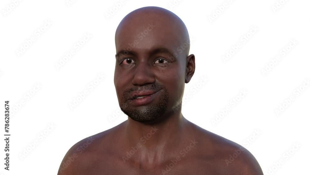 A man with facial palsy, photorealistic 3D animation highlighting the ...