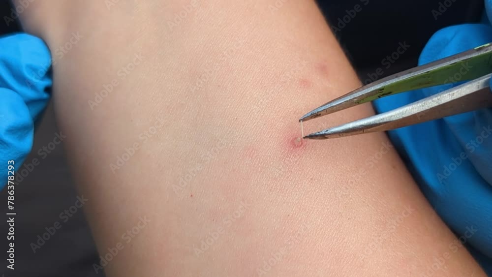 Incision and treatment of a purulent fistula on a person's skin in the ...