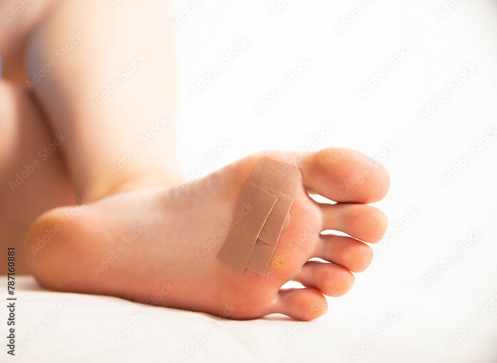 Human foot with a large callus and chicken jowl wart on a white ...
