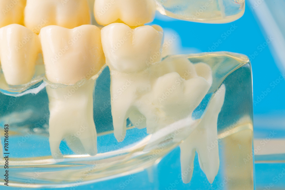 Model of a medical dental jaw with erupted wisdom teeth. Inflammation ...