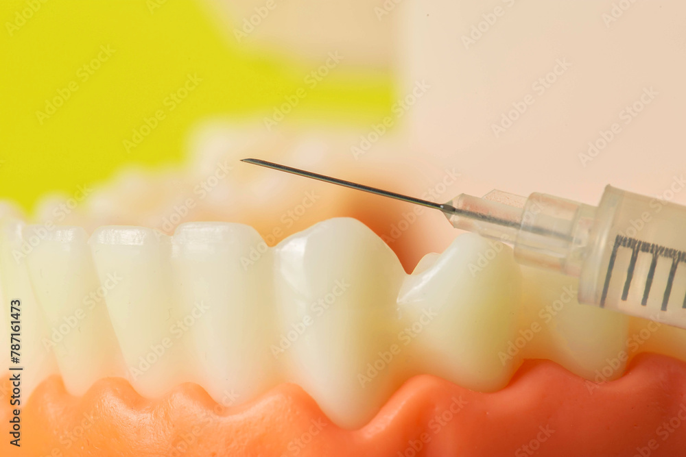 Injection of an anesthetic drug into the gum of a diseased tooth for ...