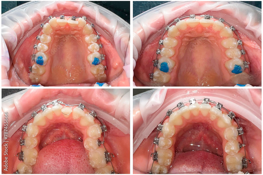 before and after braces are installed. Upper and lower jaw. Correction ...
