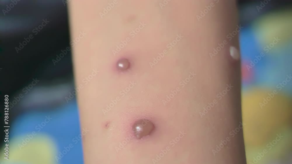 4K Educational Insight: Monkeypox-Like Blisters on Child’s Skin – Close ...