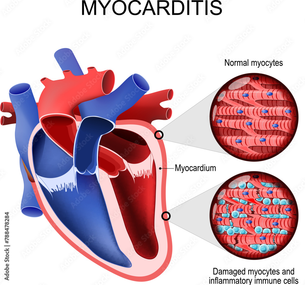 Myocarditis Inflammatory Cardiomyopathy Cross Section Of A Human Heart And Myocardium 素材庫向量圖