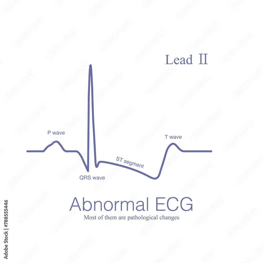 Abnormal ECG refers to changes in depolarization waves and or ...