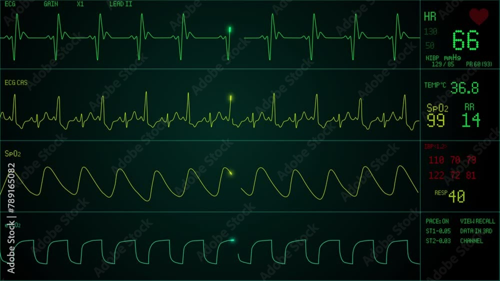 Patient monitor displays vital signs ECG electrocardiogram EKG, oxygen ...