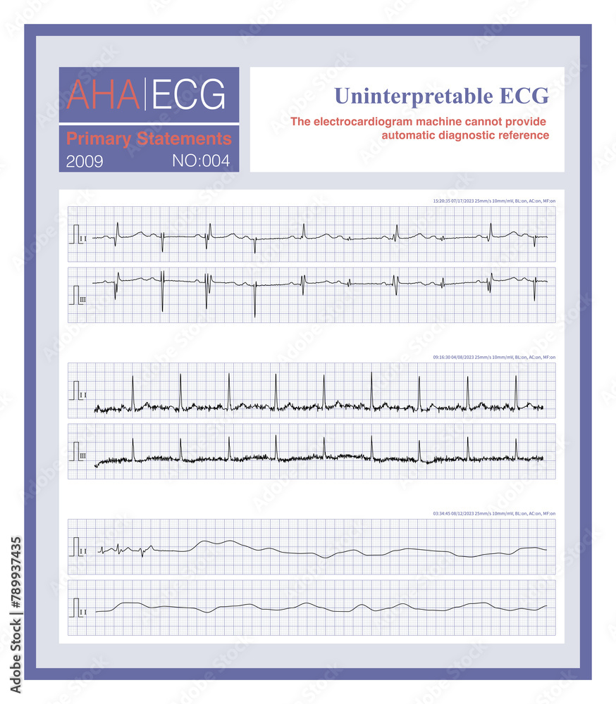 When the ECG is too complex, the recording quality is poor, or it is ...