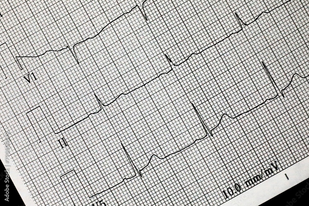 Electrocardiography (ECG or EKG) graph showing heart activity Stock ...
