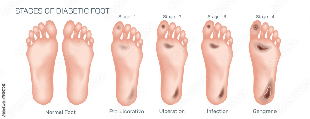 Diabetic foot refers to a group of complications that can arise in the ...