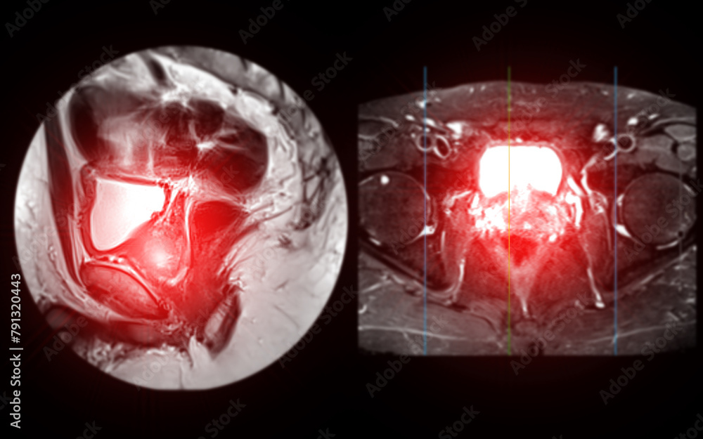 MRI of the prostate gland reveals Focal abnormal SI lesion at left PZpl ...