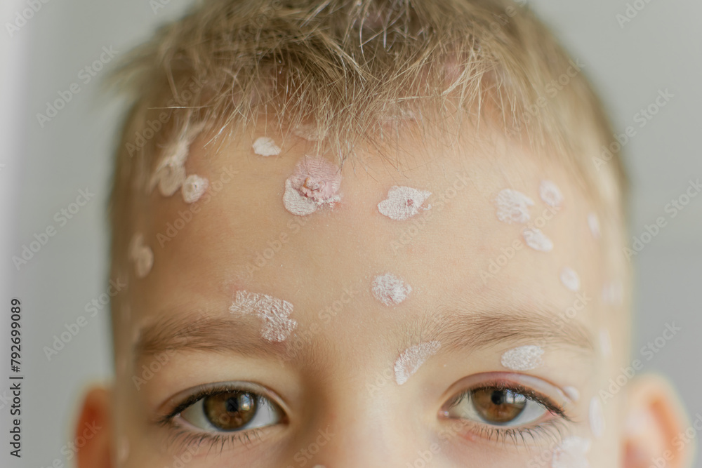 chickenpox on the face of a small child. skin disease. a childhood ...
