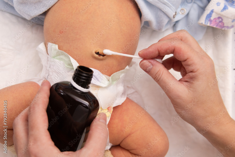 Cleaning newborn baby umbilical cord with a cotton swab, treat the ...