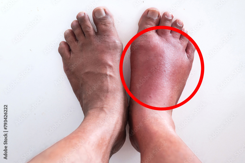 Compare swollen feet from tick bites with normal feet on white ...
