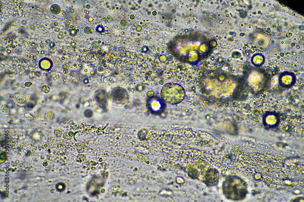 Coughing up mucus and phlegm from a chest infection from a virus and ...