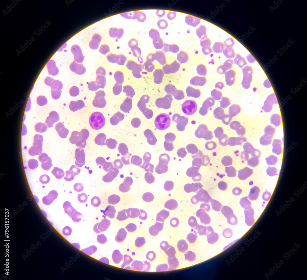 Giant platelets, Neutrophils and Red blood cells (RBC) analysed by ...