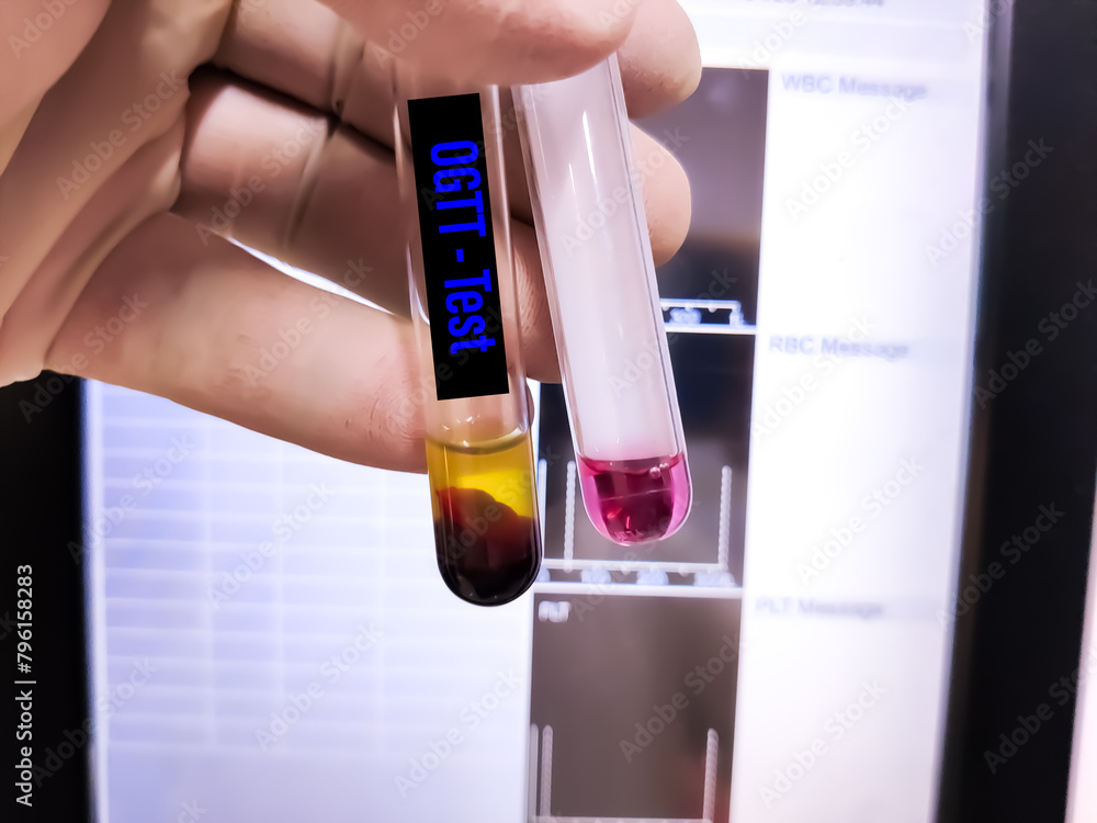 Blood sample for OGTT (Oral Glucose Tolerance Test) testing at medical ...