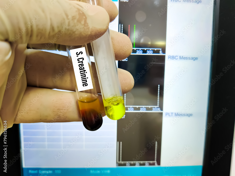 Blood sample for Serum Creatinine biochemical test. Testing by kinetic ...