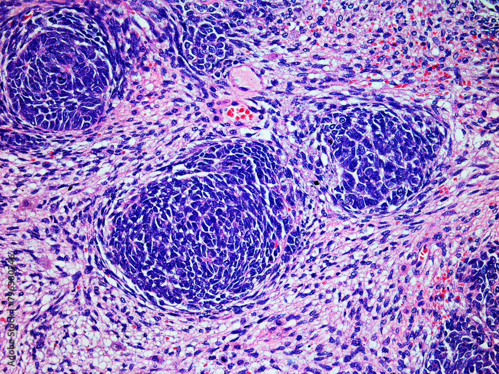 Microscopic Image of a Wilms Tumor or Nephroblastoma of a Childs Kidney ...