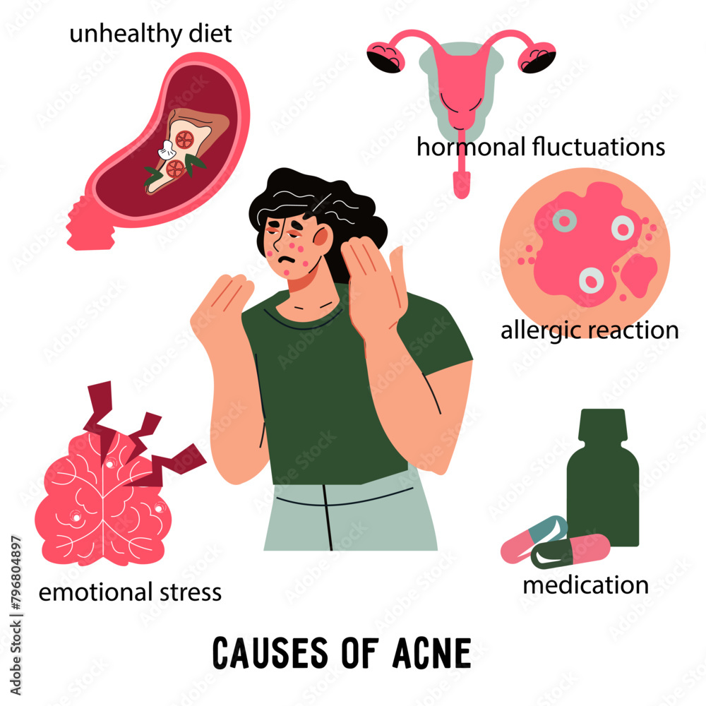 Poster about the causes of acne and how to care for skin through ...