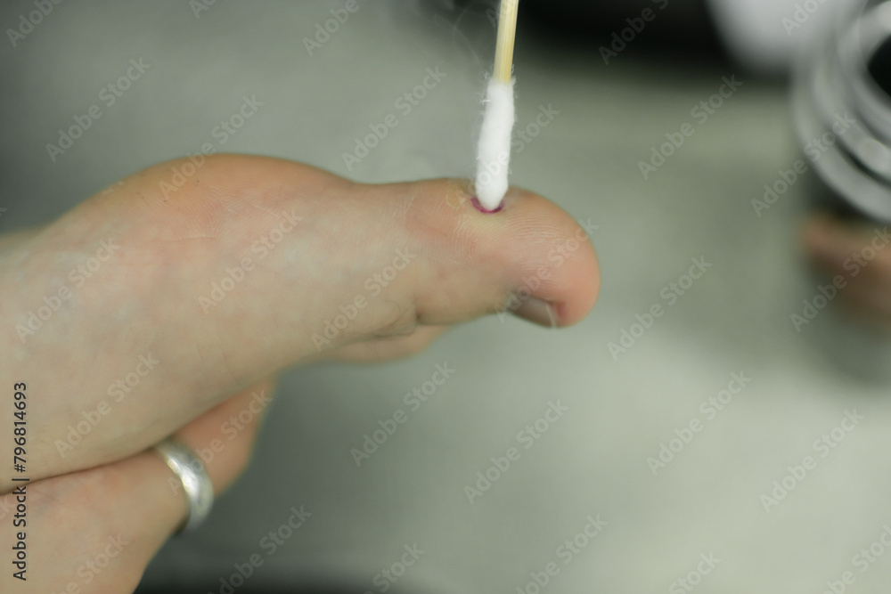 A dermatologist treats a wart with liquid nitrogen on a patient’s leg ...