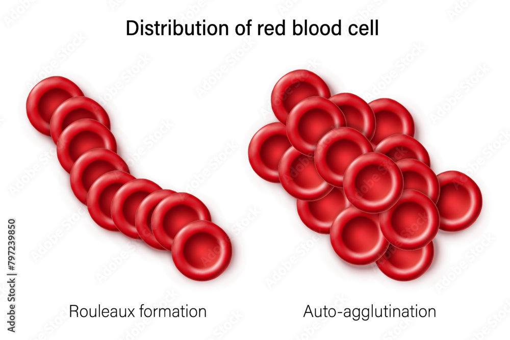 Distribution of red blood cell. Auto-agglutination and Rouleaux ...
