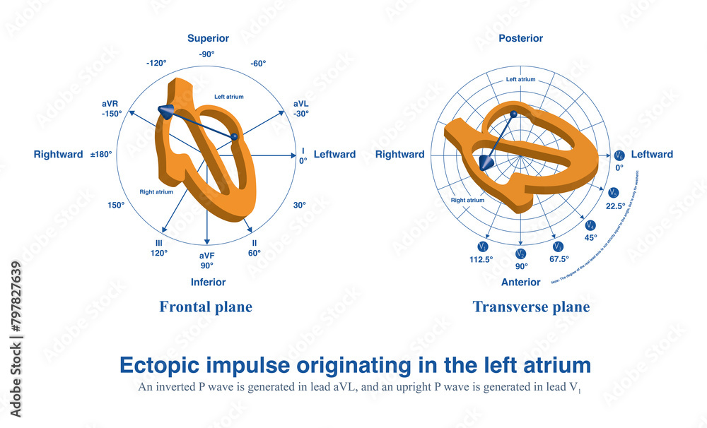 When ectopic impulses originate in the left atrium, an upright P wave ...