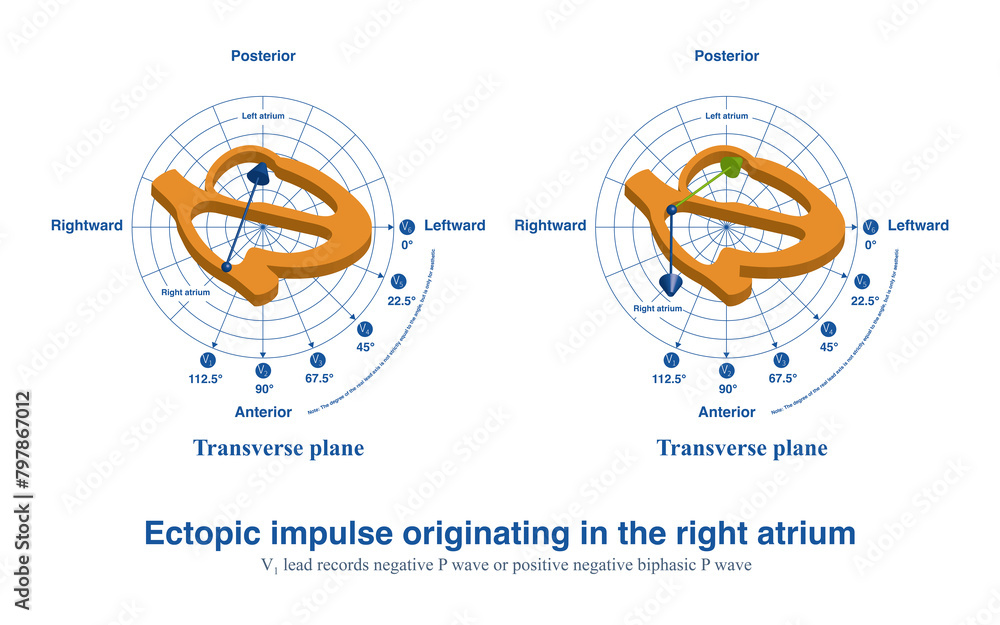 When ectopic impulses from the anterior wall of the right atrium ...