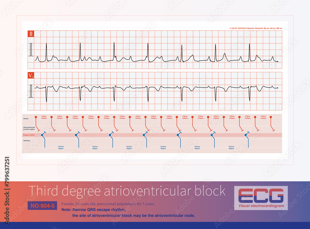 Third degree atrioventricular block in young women may be congenital ...