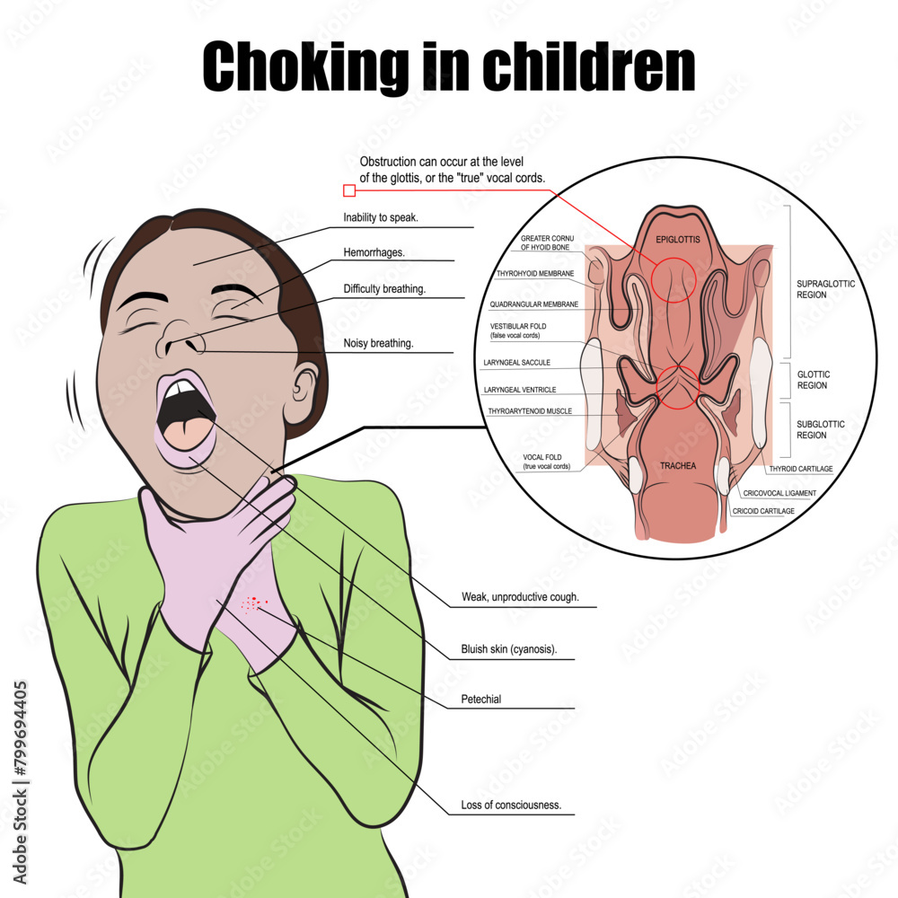 Asphyxiation in children, lodging of an object blocking the trachea ...