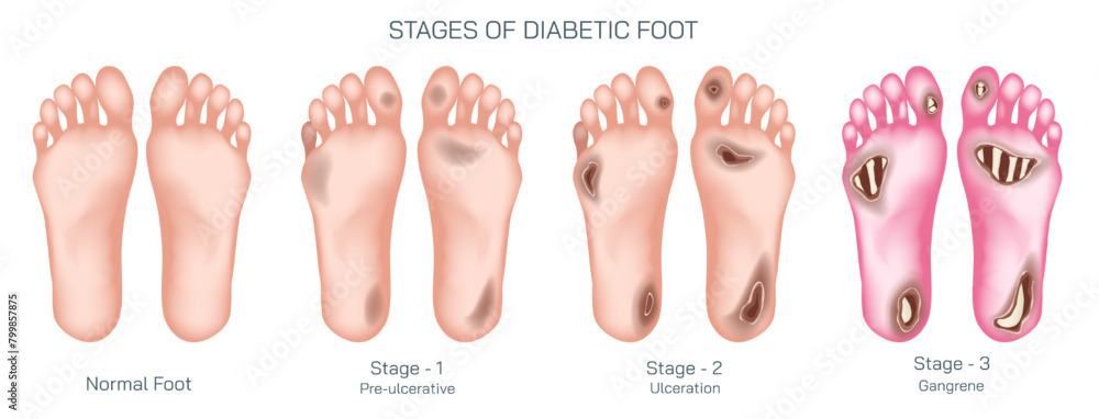 Diabetic foot refers to a group of complications that can arise in the ...