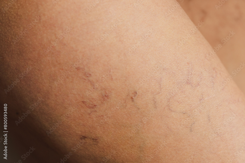 Varicose veins. Vascular diseases. Varicose veins of small vessels on ...