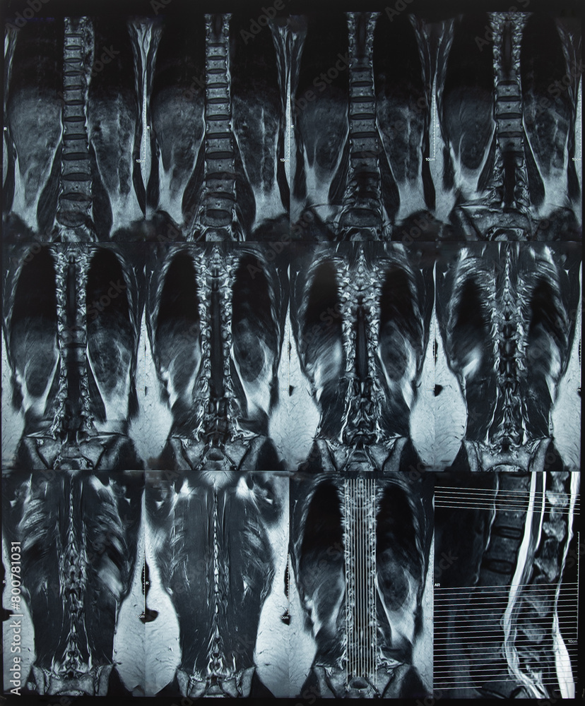 x-ray thoracic and lumbar vertebrae spine x-ray film images by mri ct ...