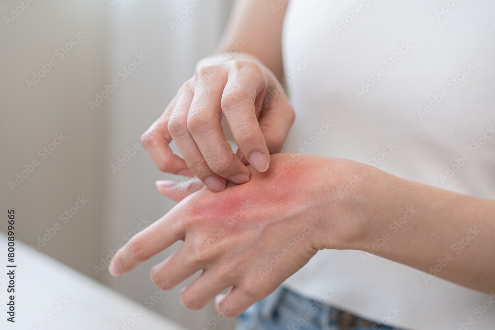 Dermatology asian young woman allergy, allergic reaction from atopic ...