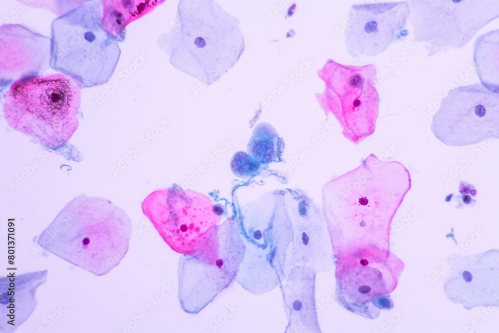 Abnormal squamous epithelial cells view in microscopy.Low grade SIL ...