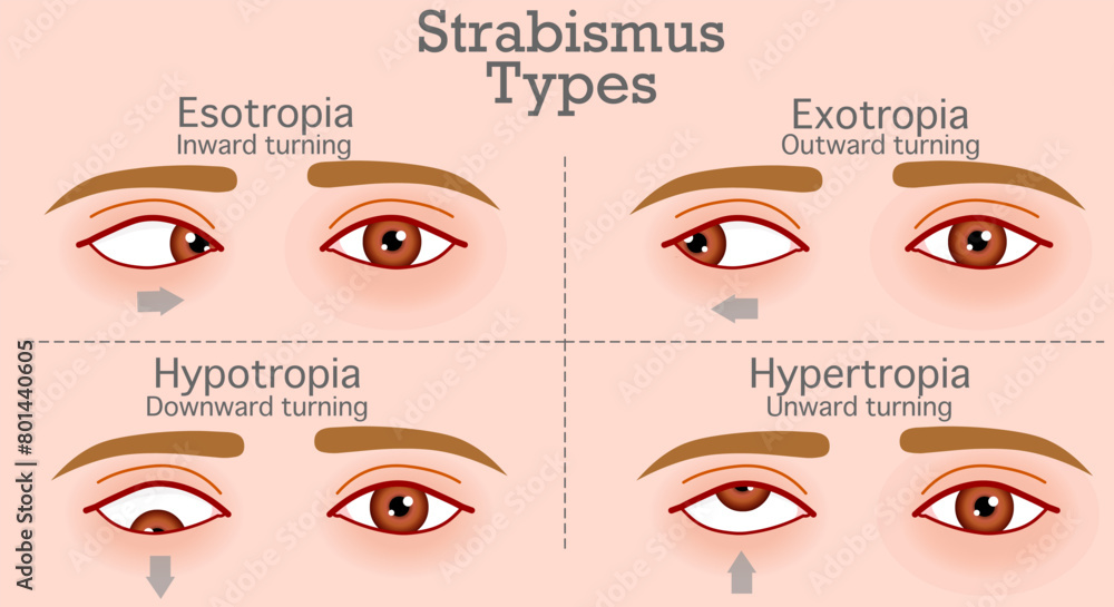 Strabismus types, crossed eyes, disease. Inward turning, outward ... Strabismus types, crossed eyes, disease. Inward turning, outward ...