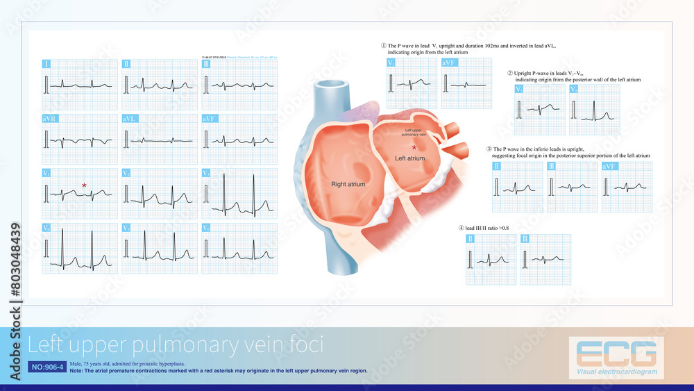 Atrial focal originating in the left upper pulmonary vein, with an ...