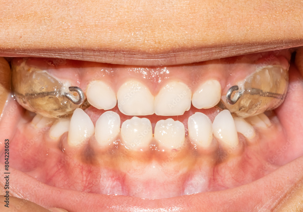 Frontal view of a young dental patient case, cheek and lips retracted ...