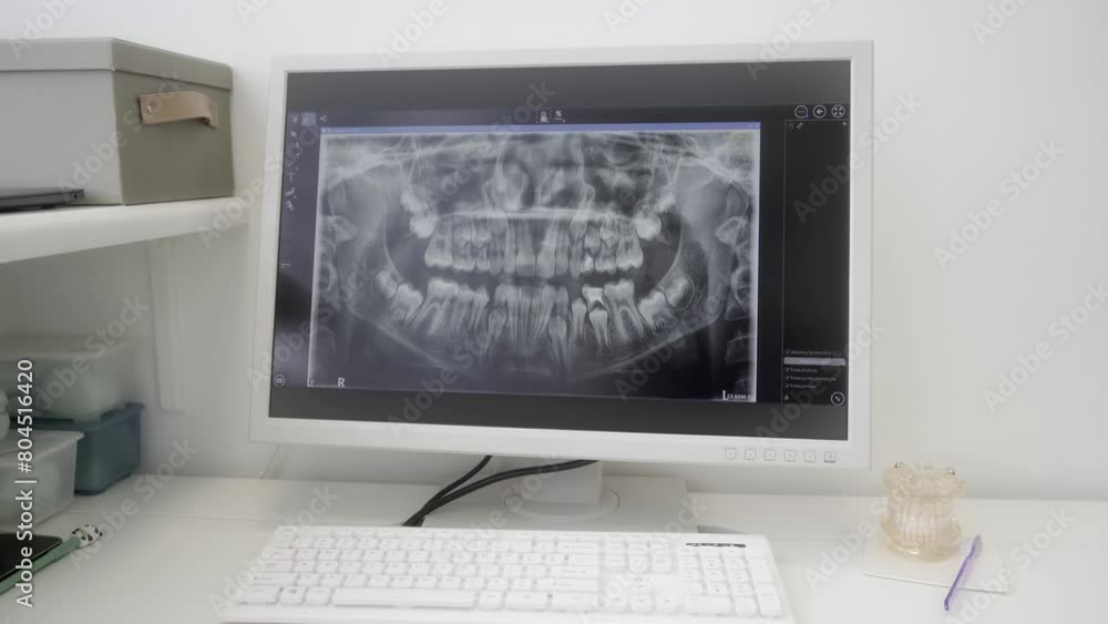 Panoramic X-ray image of baby teeth and jaw of a child on a computer ...