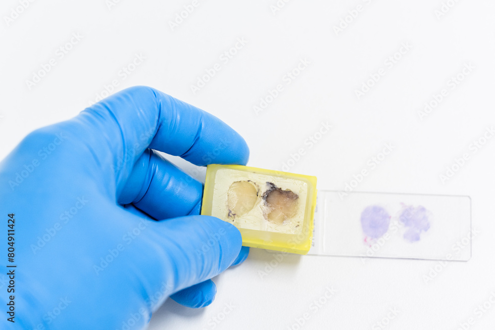 Scientist wear blue glove holding paraffin human tissue block and out ...