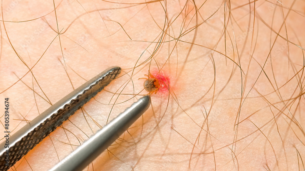 Professional dermatologist using specialized tweezers to remove ...