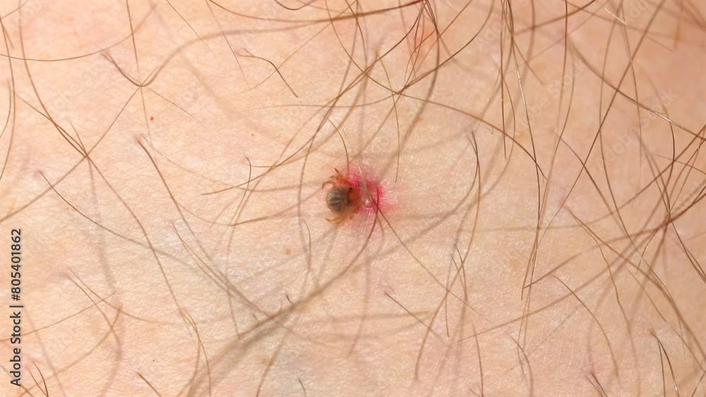 Close-up view of bee sting on human skin causing allergic reaction with ...