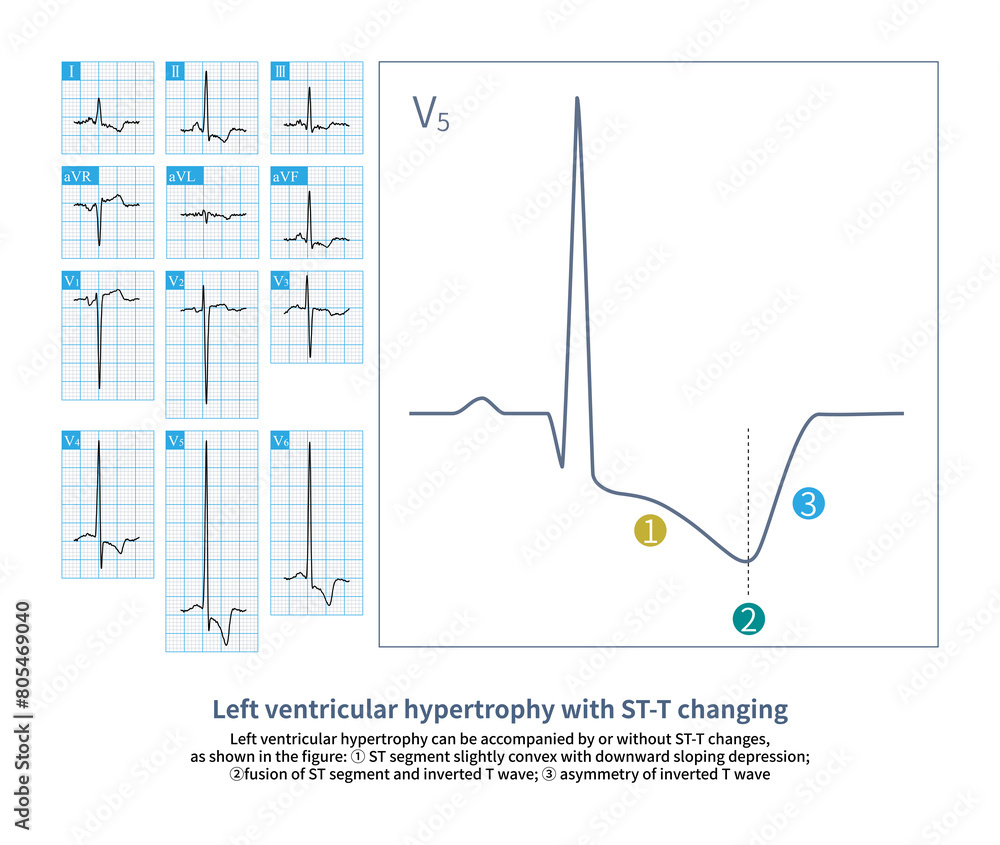 The typical ST-T changing of left ventricular hypertrophy are: ① ST ...