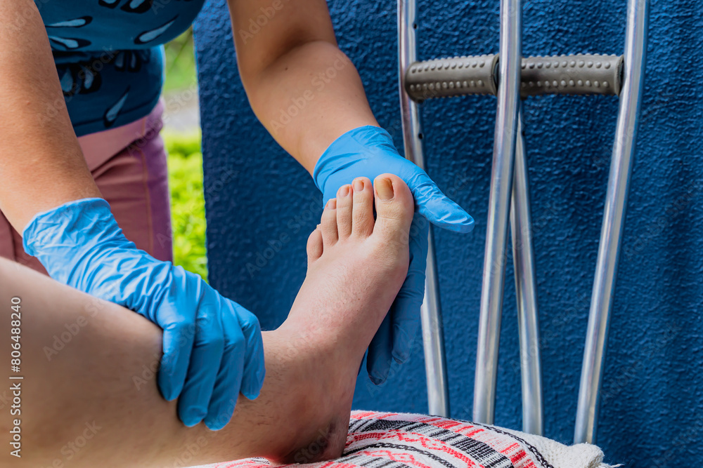 Domestic nurse giving therapy to young woman with broken foot outdoors ...