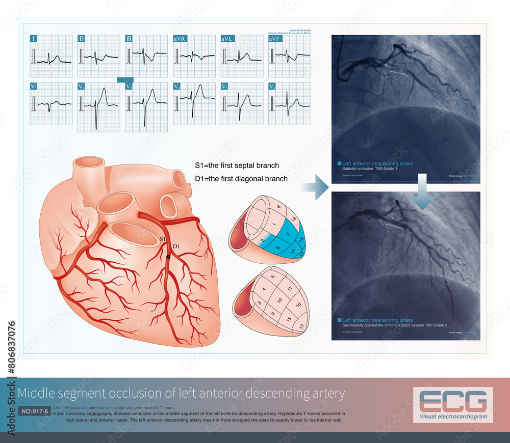 Male, 65 years old, was clinically diagnosed with acute anterior ...