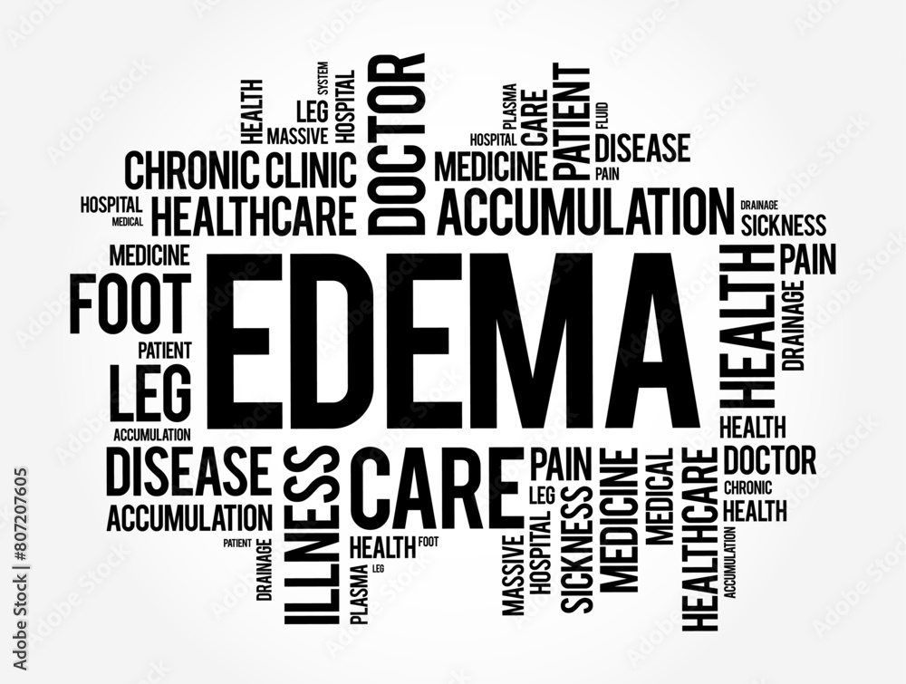 Edema is swelling caused by excess fluid trapped in your body's tissues ...