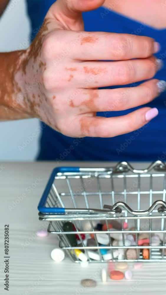 Vitiligo disease on the hands of a young girl. Depigmentation of areas ...
