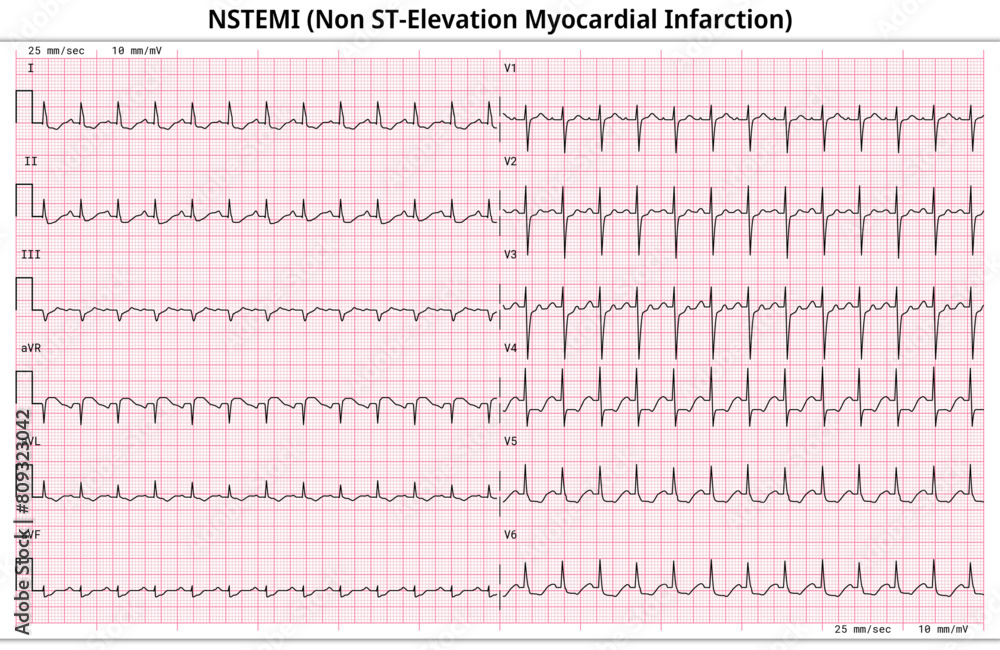 Poster Non ST-Elevation Myocardial Infarction (NSTEMI) - ECG Paper 12 Lead - 6 Sec/lead – Zidna ...