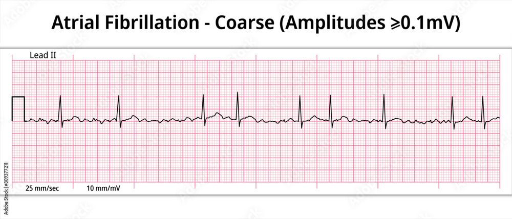 Coarse Atrial Fibrillation - 8 Second ECG Paper - Electrocardiography ...