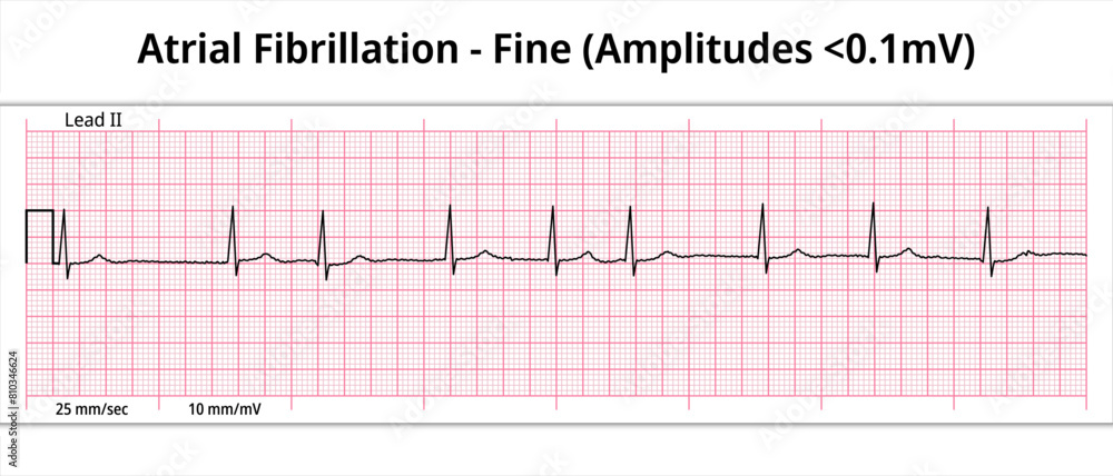 Poster Fine Atrial Fibrillation - 8 Second ECG Paper ...