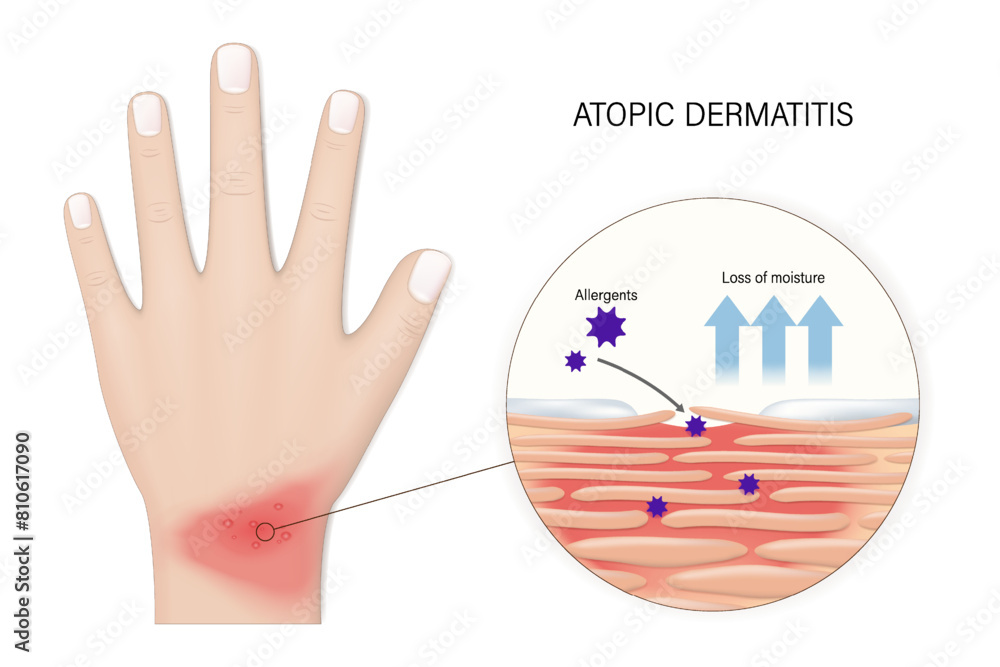 Eczema Atopic Dermatitis Vector Close Up Of Human Skin With